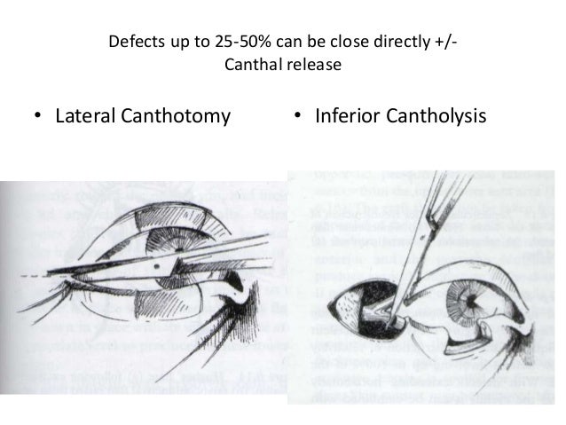 Upper eyelid reconstruction