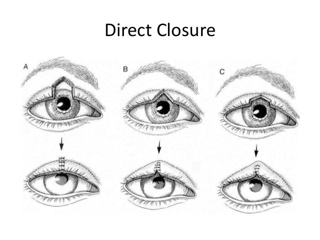 Upper eyelid reconstruction
