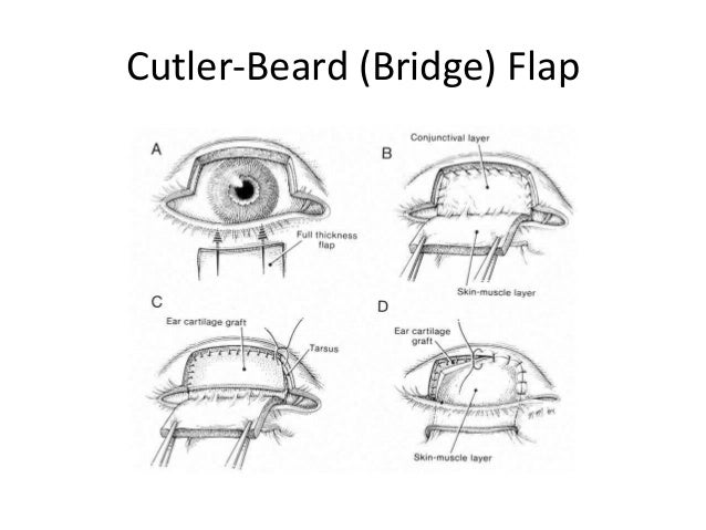 Upper Eyelid Reconstruction