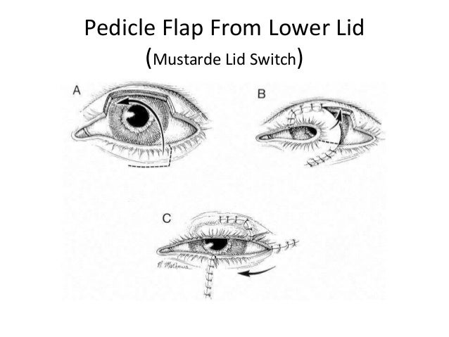 Upper eyelid reconstruction