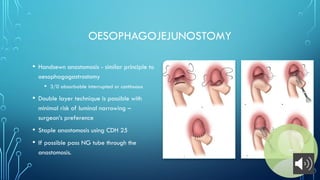 upper GI anastomosis principles - master of surgery | PPTX