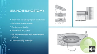 upper GI anastomosis principles - master of surgery | PPT
