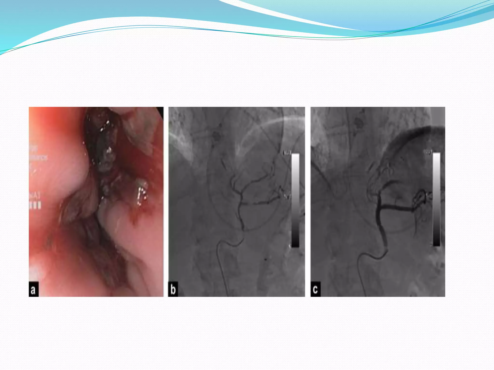 UPPER GI BLEED.pptx | Blood Disorders | Diseases and Conditions