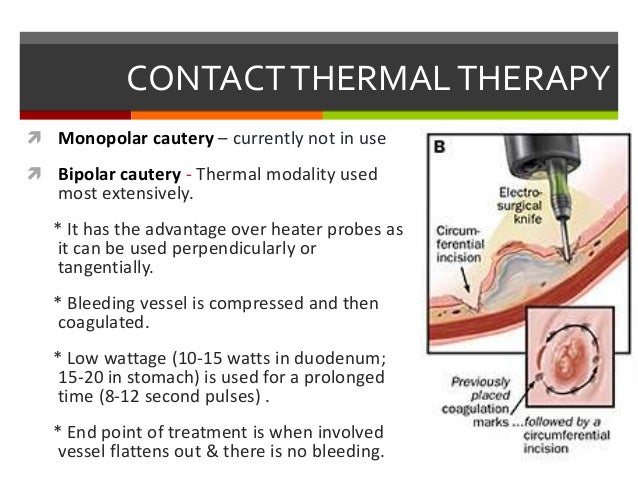 Approach to Management of Upper Gastrointestinal (GI) Bleeding