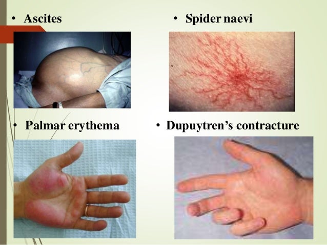 Uppergibleeding 150402032909-conversion-gate01-converted