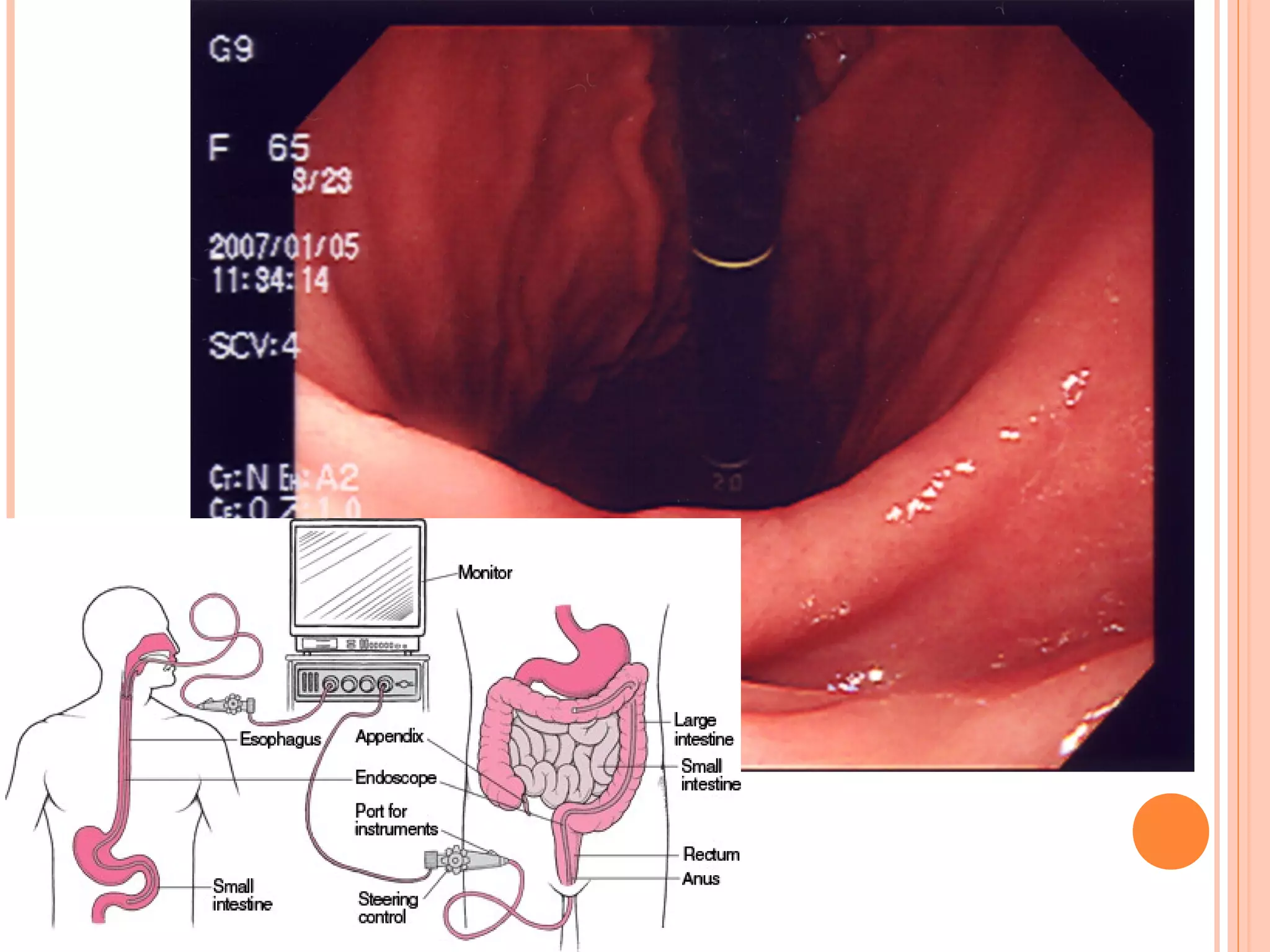Upper Gastrointestinal bleeding | PPT