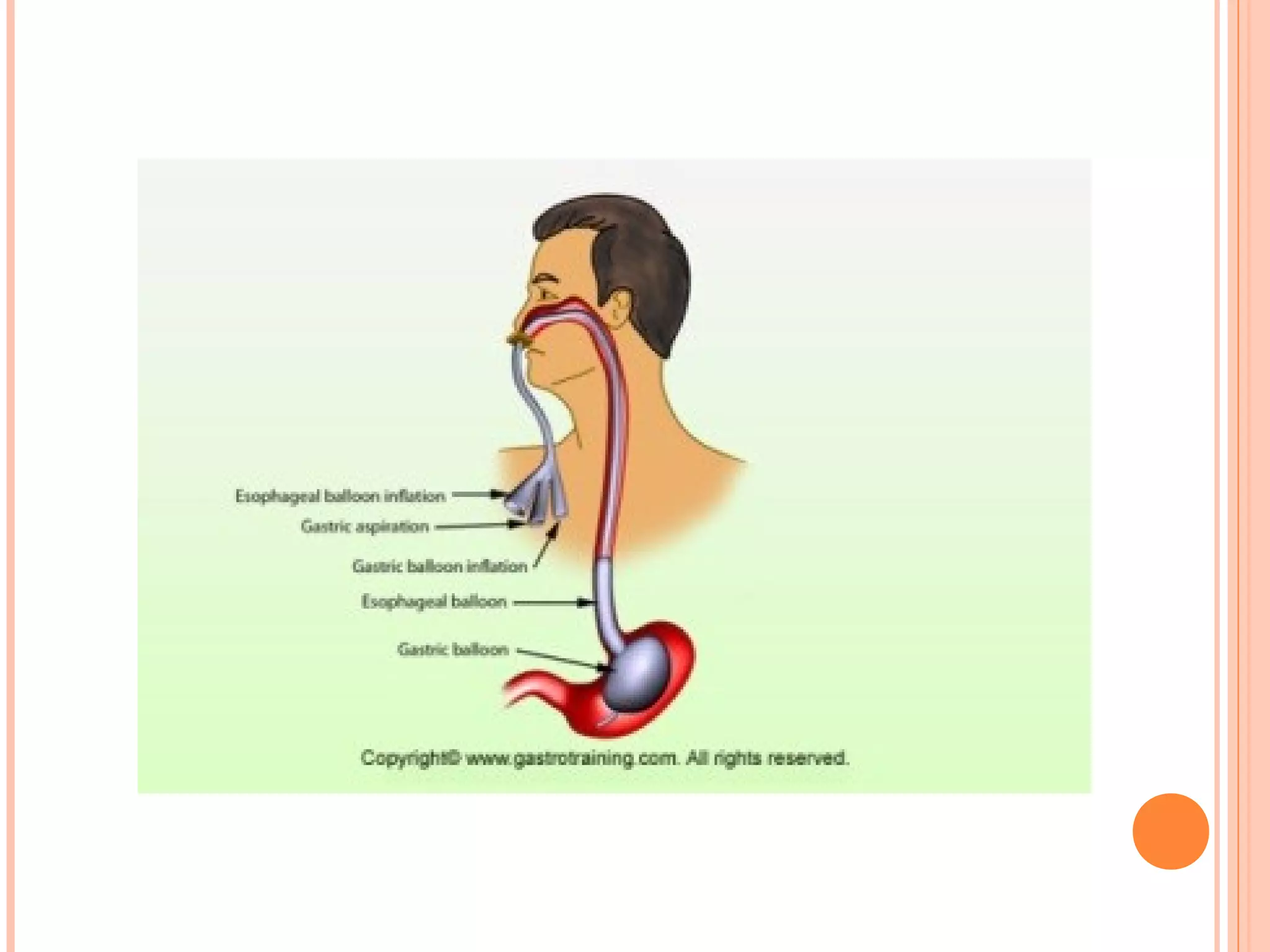 Upper Gastrointestinal bleeding | PPT
