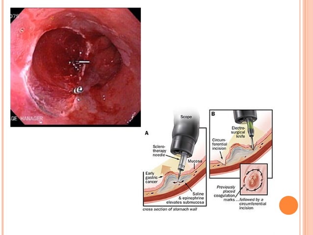 Upper Gastrointestinal bleeding | PPT | Blood Disorders | Diseases and ...