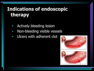 Upper gi bleeding management | PPTX