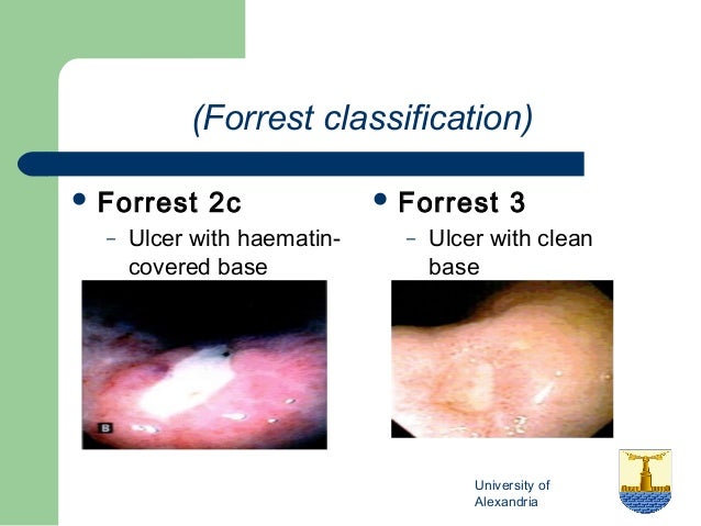 Upper gastrointestinal bleeding