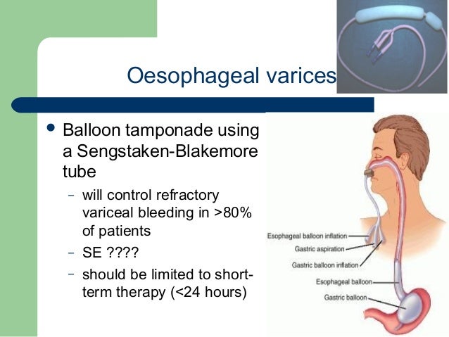 Upper gastrointestinal bleeding