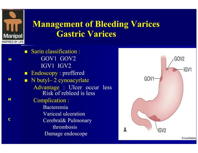 Upper GI Hemorrhage-- Surgical perspective | PDF