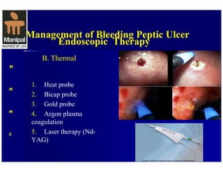 Heater Probe Endoscopy