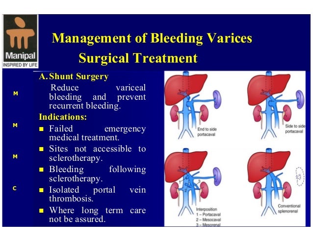 Upper GI Hemorrhage-- Surgical perspective