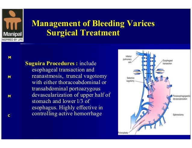 Upper GI Hemorrhage-- Surgical perspective