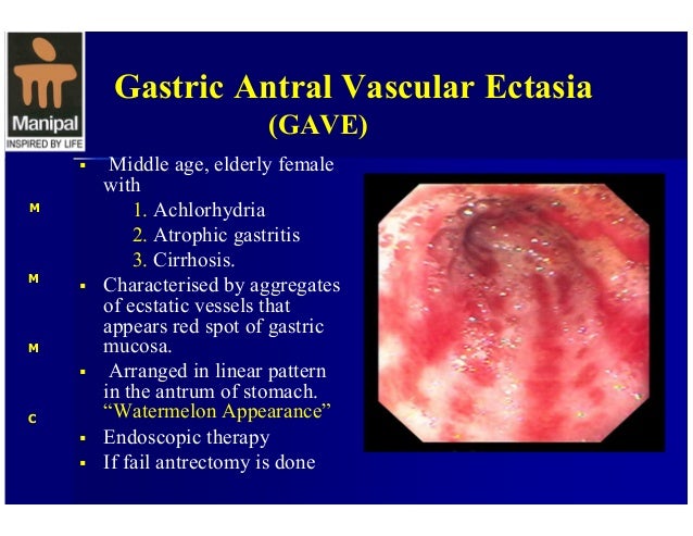 Upper GI Hemorrhage-- Surgical perspective