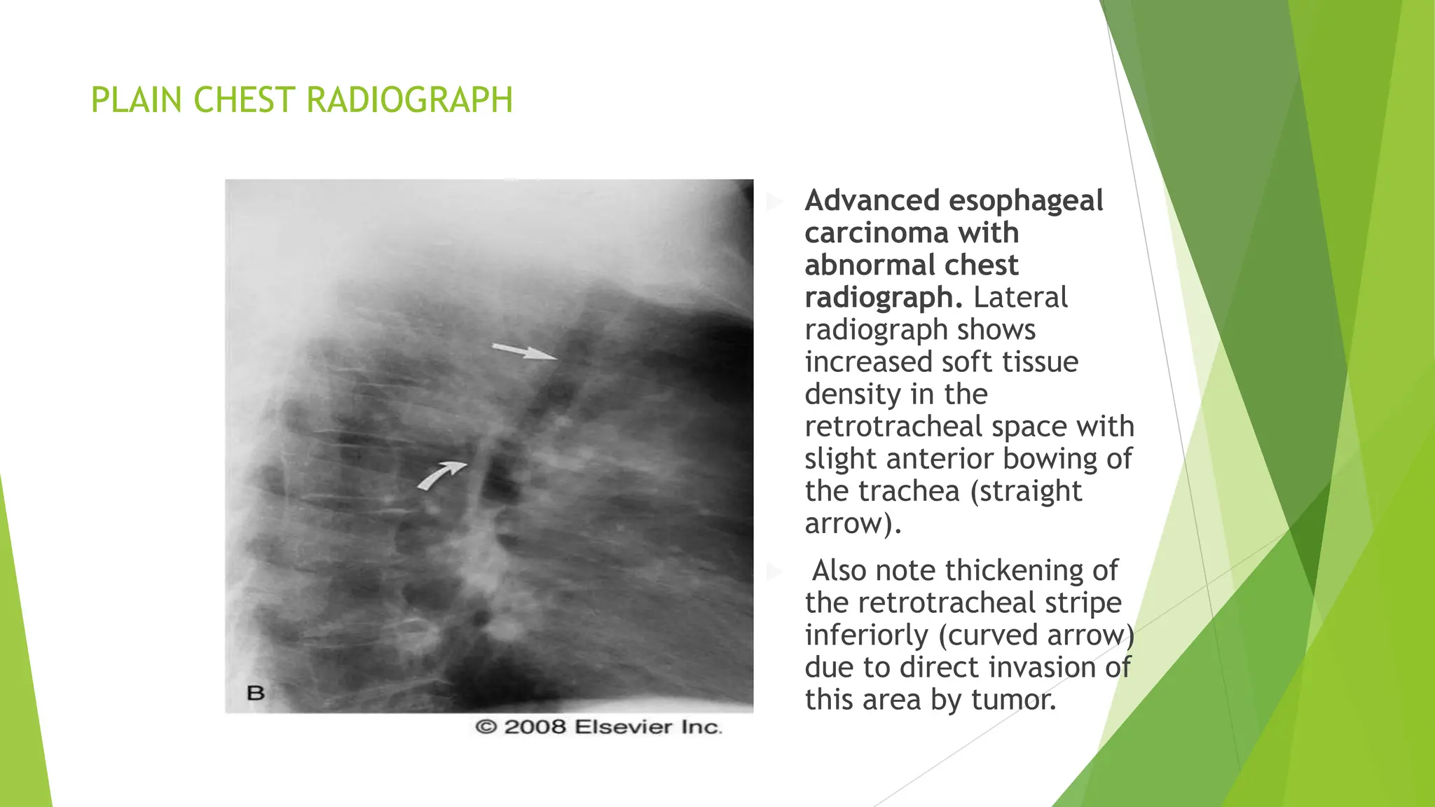 UPPER GI PATH SMD.pptx on upper GI bleeding | PPT
