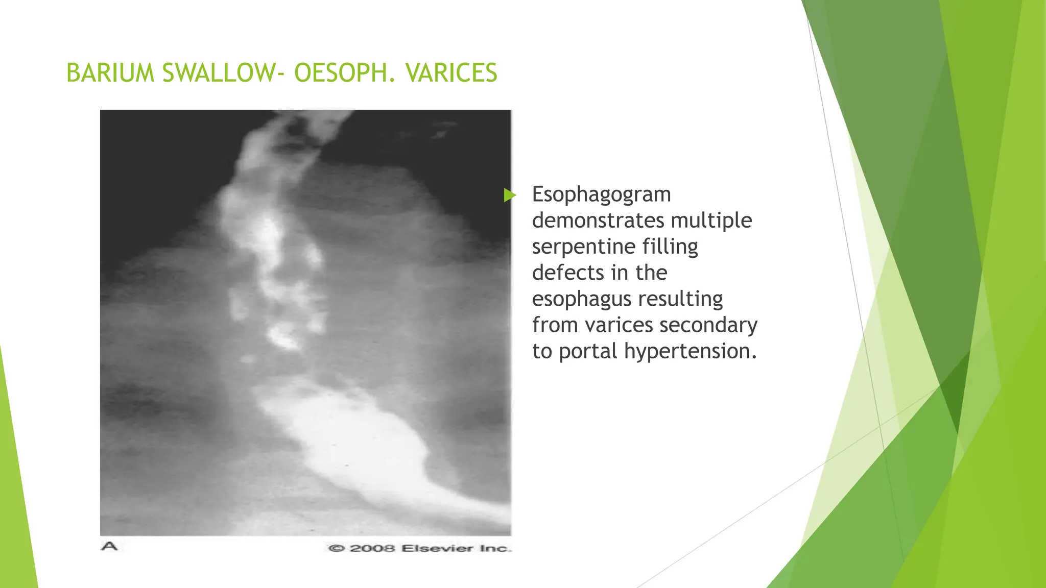 UPPER GI PATH SMD.pptx on upper GI bleeding | PPT