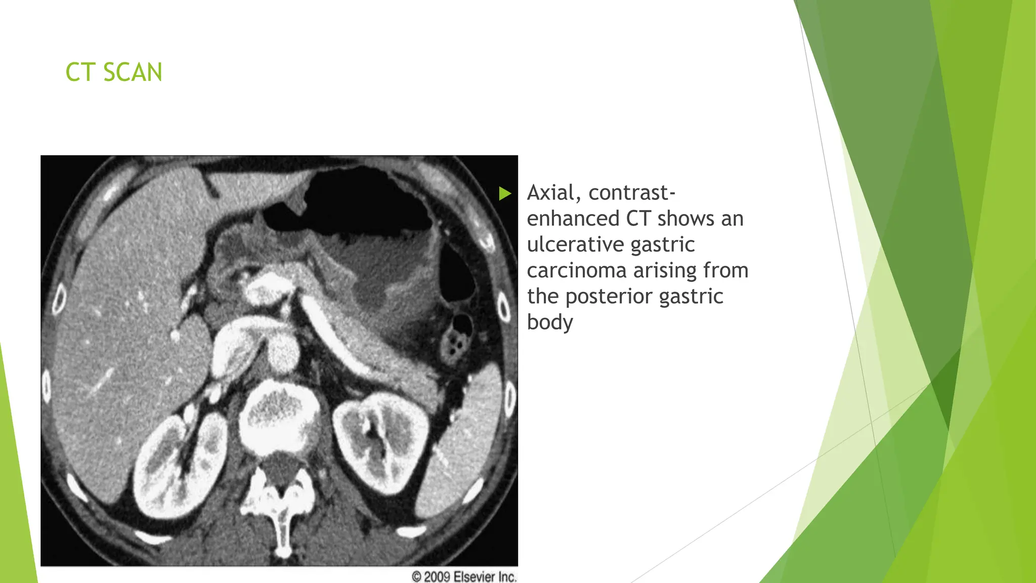 UPPER GI PATH SMD.pptx on upper GI bleeding | PPT