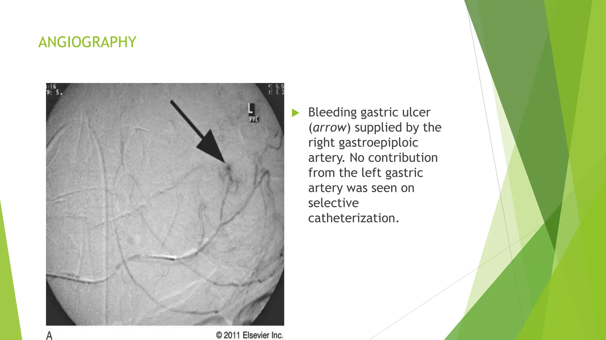 UPPER GI PATH SMD.pptx on upper GI bleeding | PPT