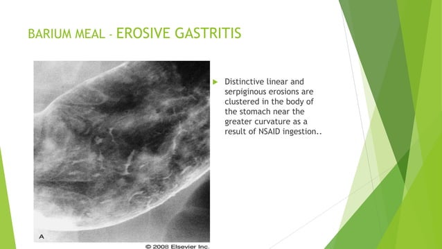 UPPER GI PATH SMD.pptx on upper GI bleeding | PPT