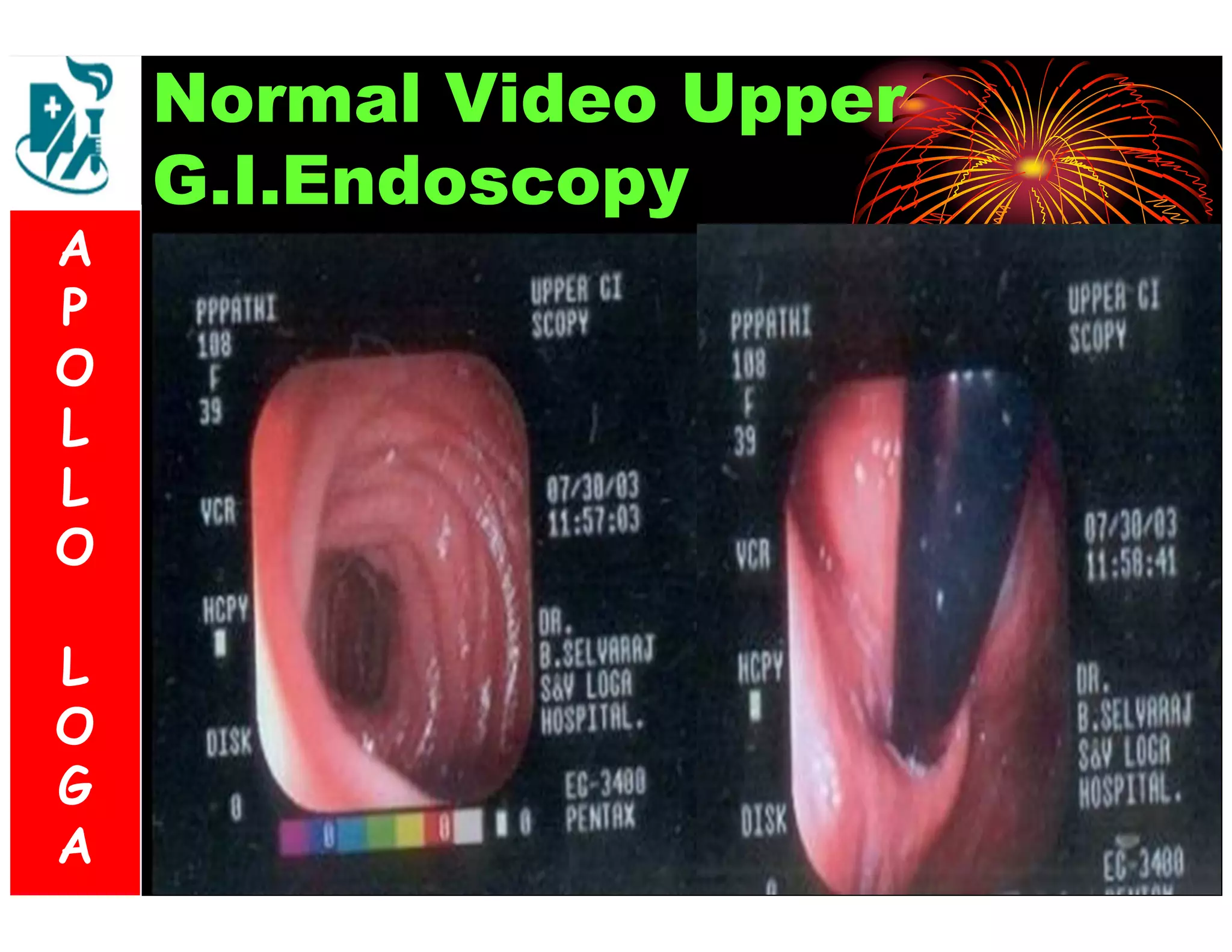 Upper GI Endoscopy - A pictorial overview | PDF