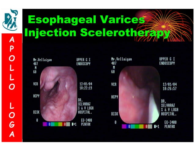 Upper GI Endoscopy - A pictorial overview | PDF
