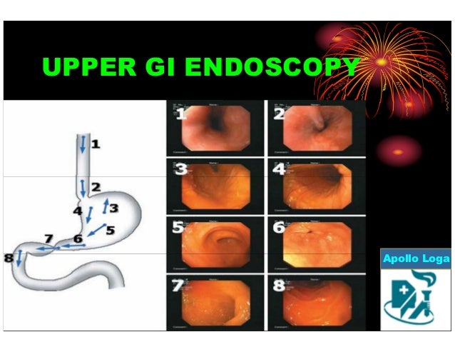 Upper GI Endoscopy - A pictorial overview