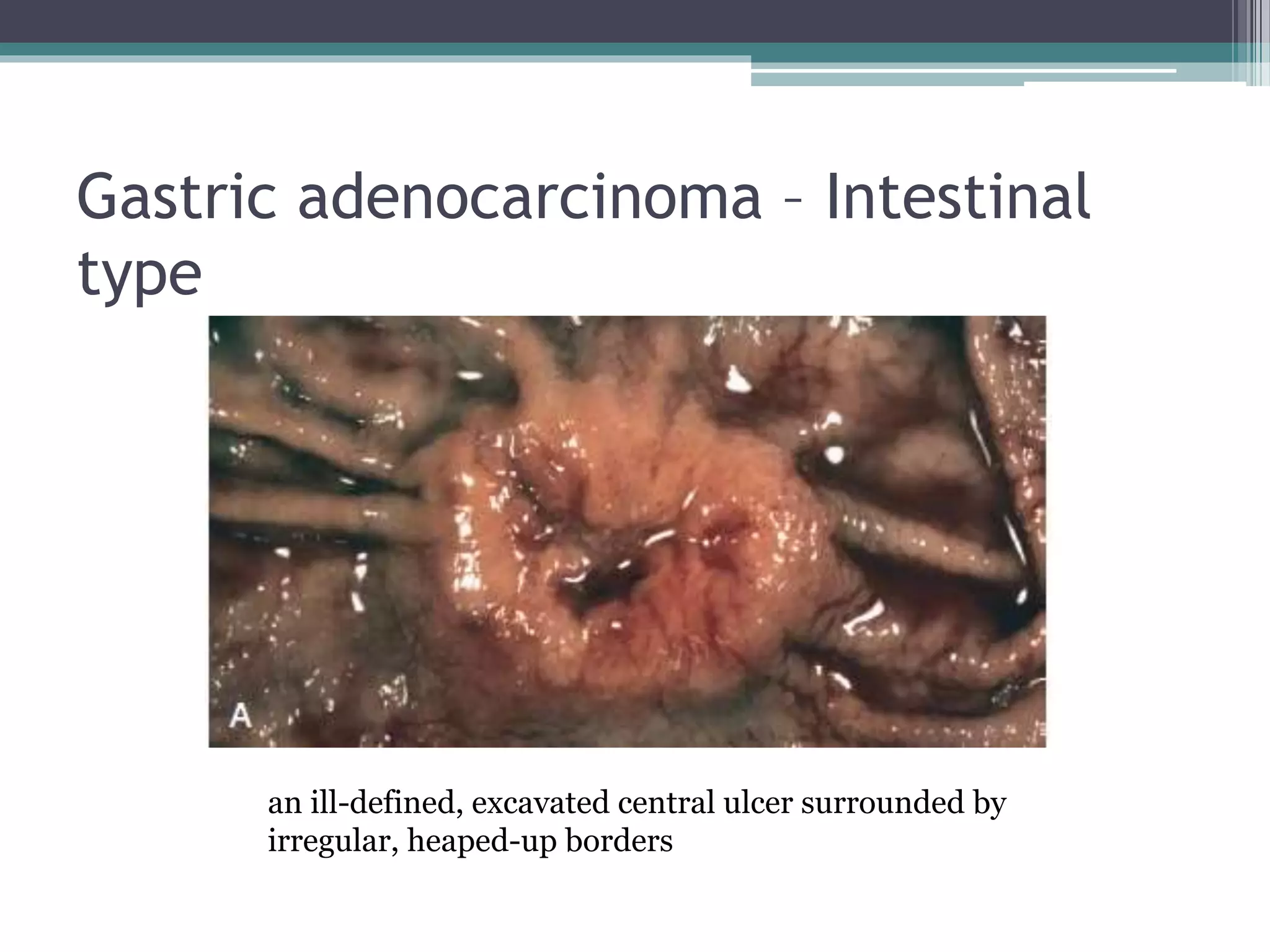 Upper git and salivary gland | PPTX