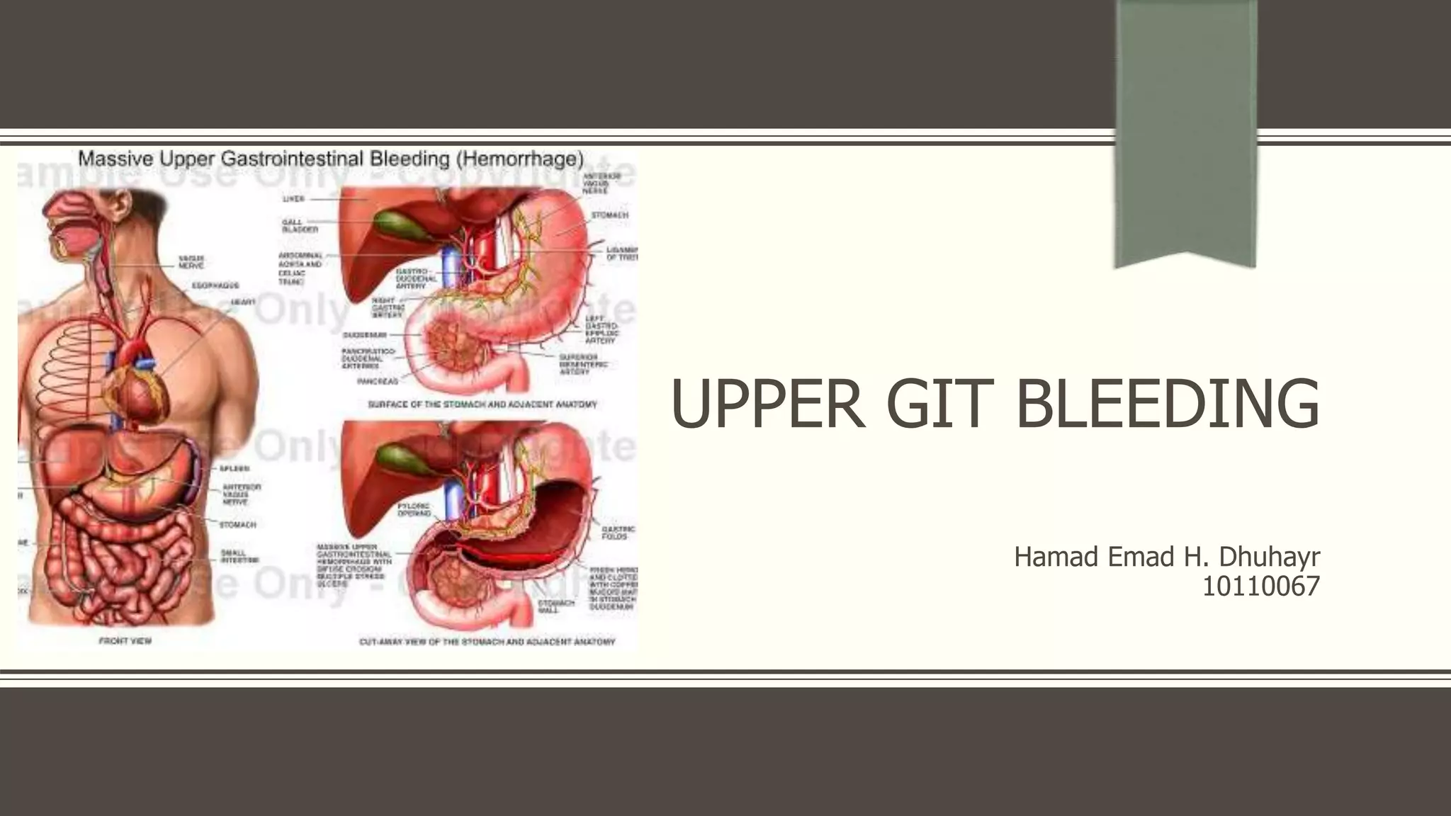 Upper git bleeding | PPT