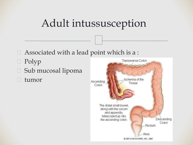 Upper Intestinal Obstruction by Dr. Aliaty | PPT