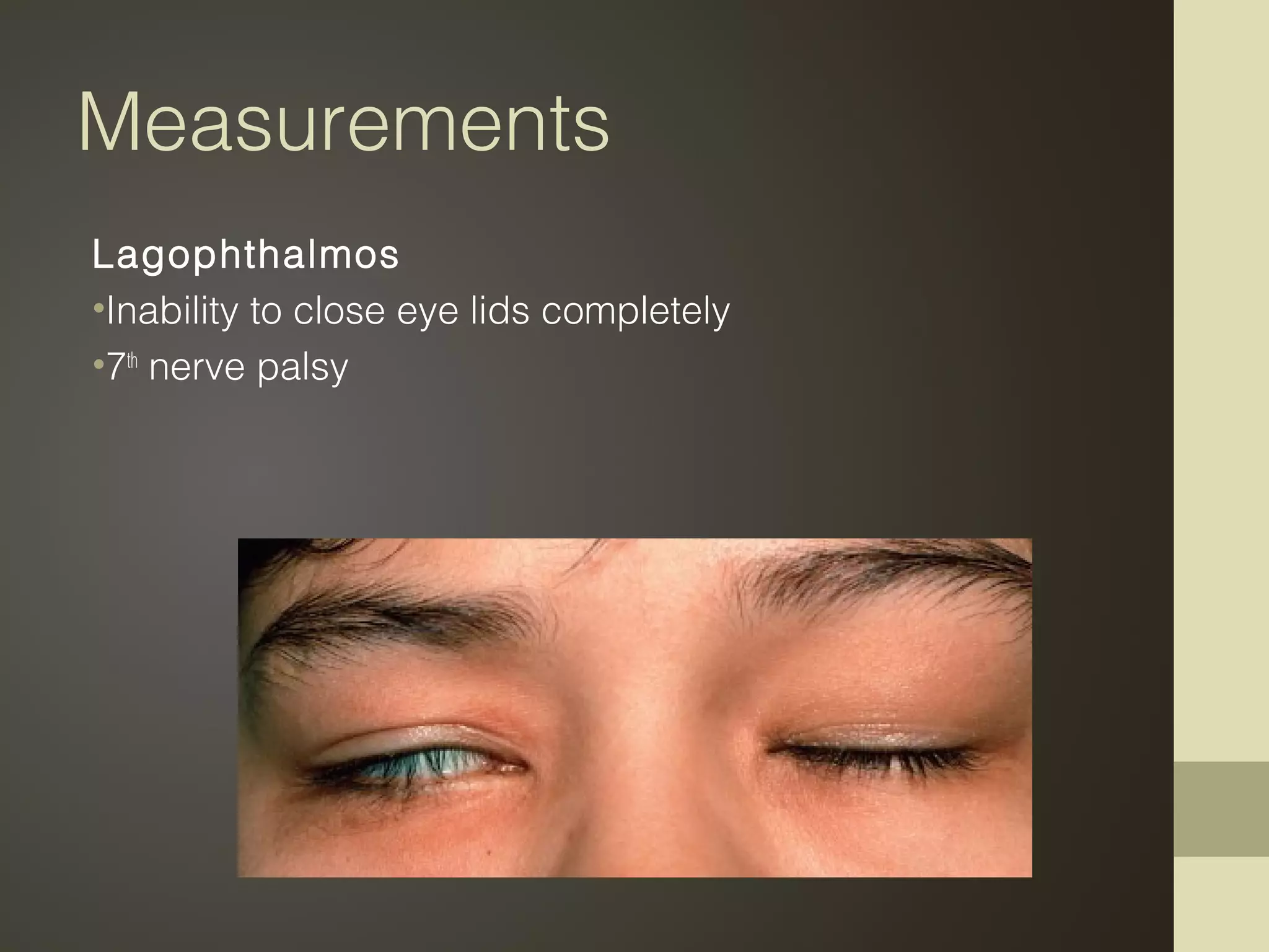 Upper Lid Ptosis | PPT