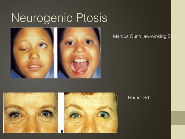 Upper Lid Ptosis | PPT | Eye and Vision Conditions | Diseases and Conditions