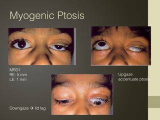 Upper Lid Ptosis | PPT
