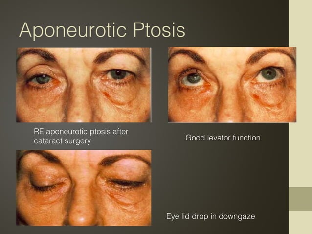 Upper Lid Ptosis | PPT | Eye and Vision Conditions | Diseases and ...