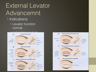 Upper Lid Ptosis | PPT