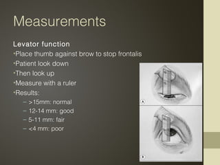 Upper Lid Ptosis | PPT