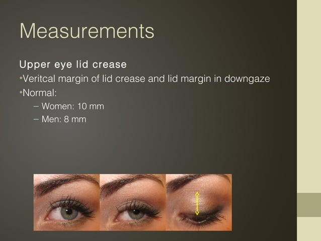 Upper Lid Ptosis | PPT
