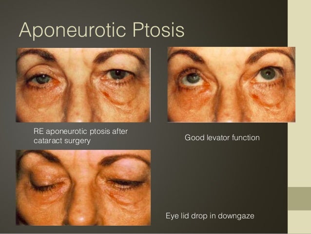 Upper Lid Ptosis