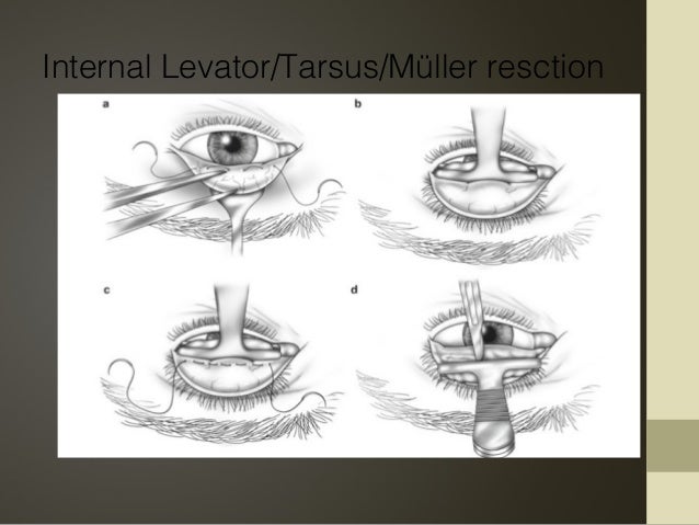 Upper Lid Ptosis