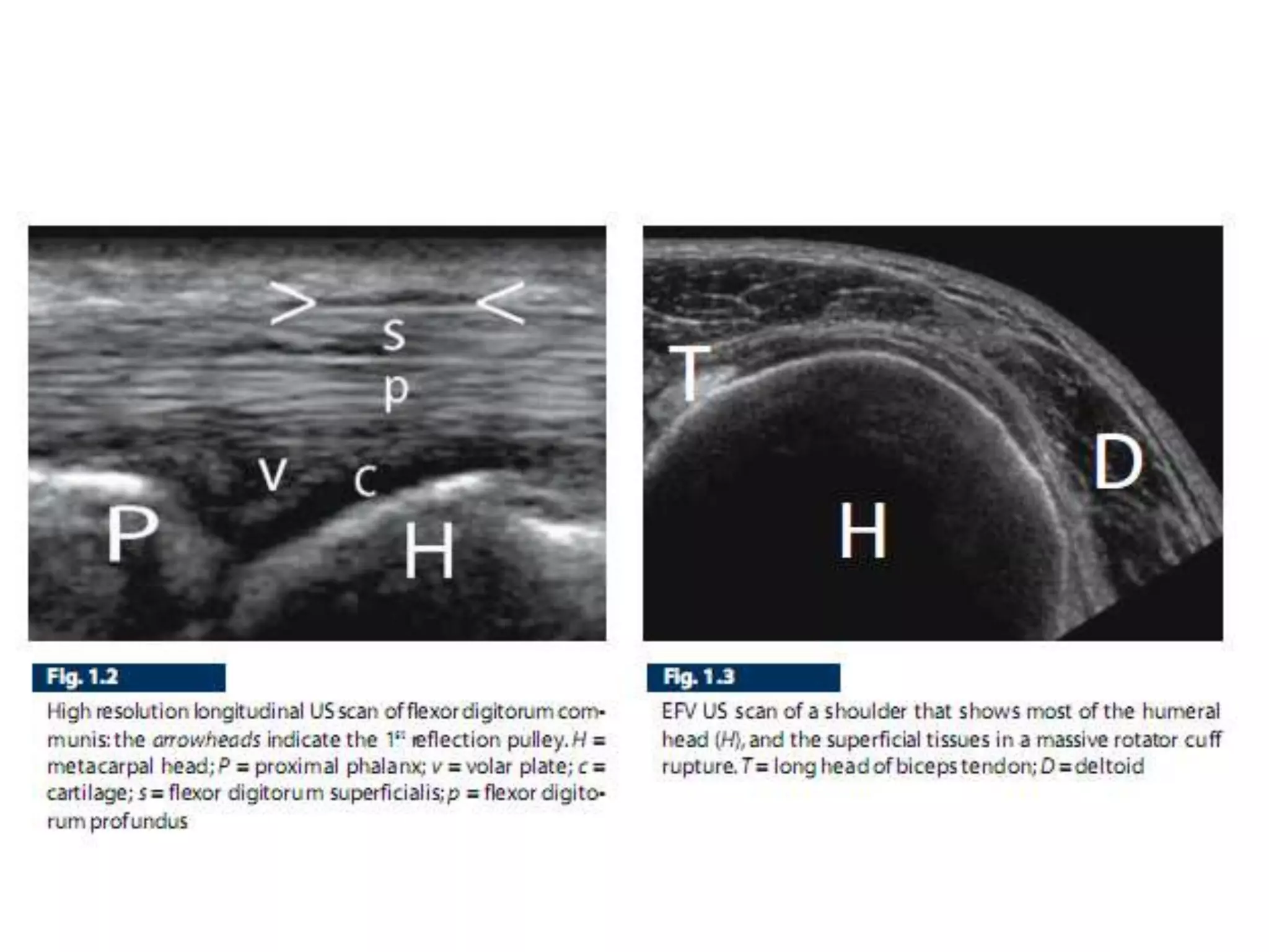 UPPER LIMB ULTRASOUND ANATOMY for Medical Students | PPTX