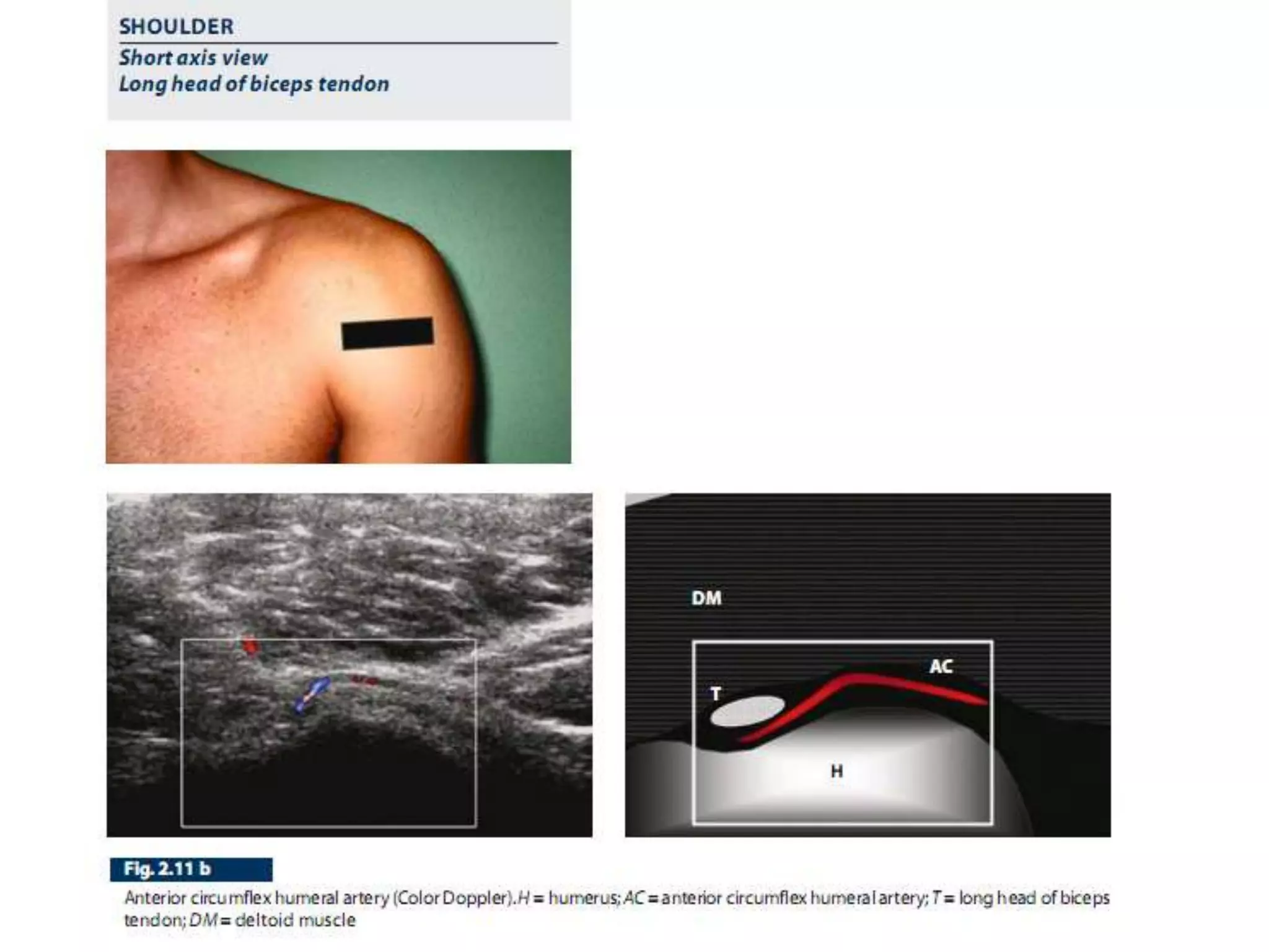 UPPER LIMB ULTRASOUND ANATOMY for Medical Students | PPTX