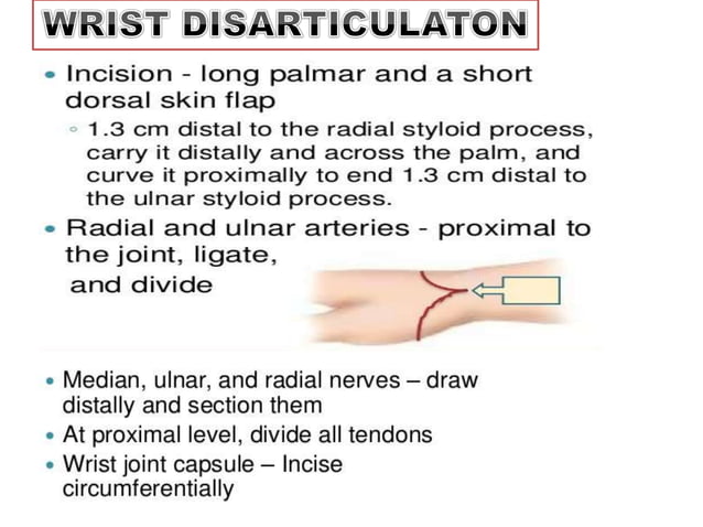 Upper Limb Amputation (Except Hand) by Dr. Arpan Chaudhary | PPT