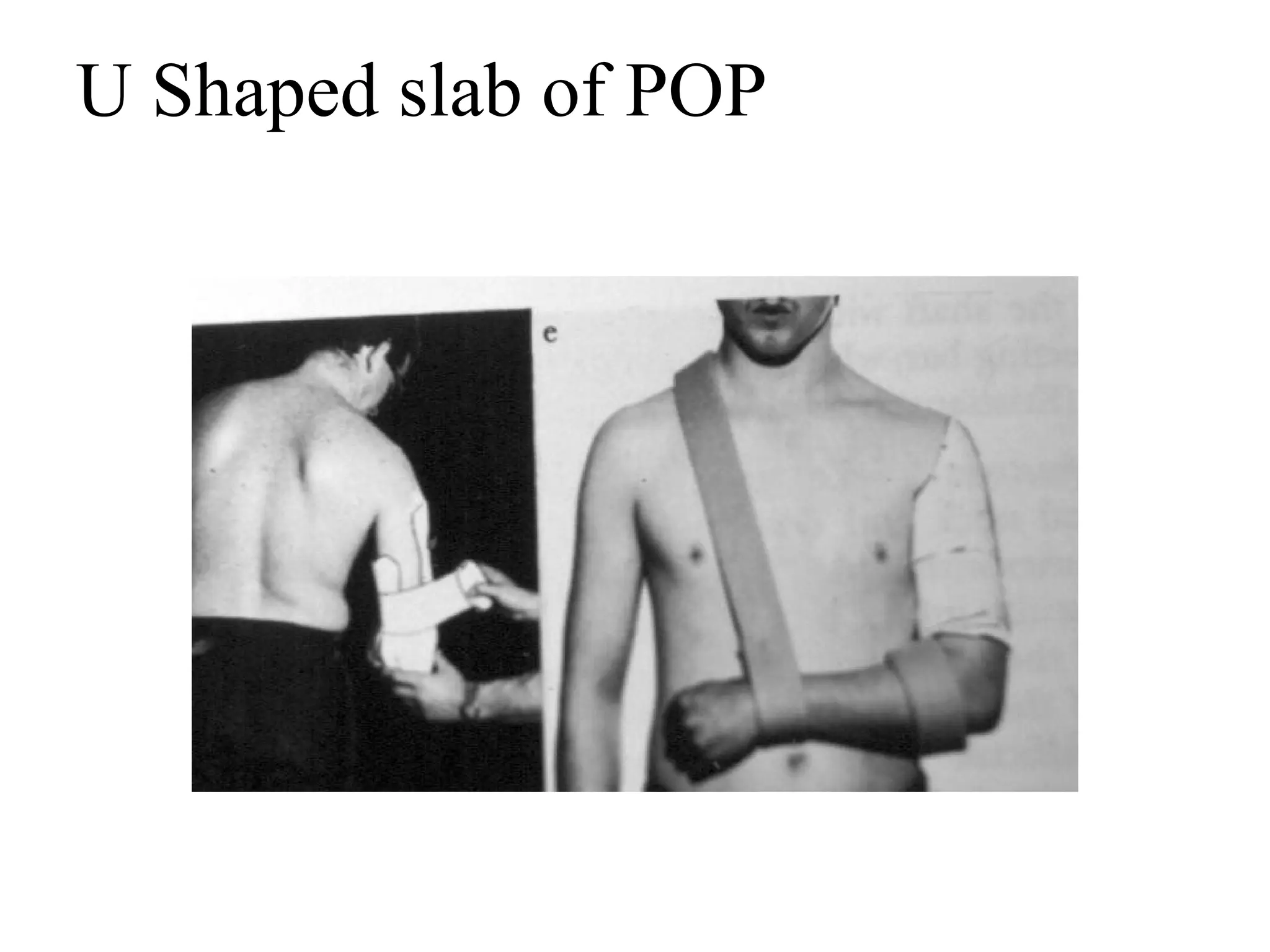 upper limb, injuries of the upper limb, detailed | PPTX
