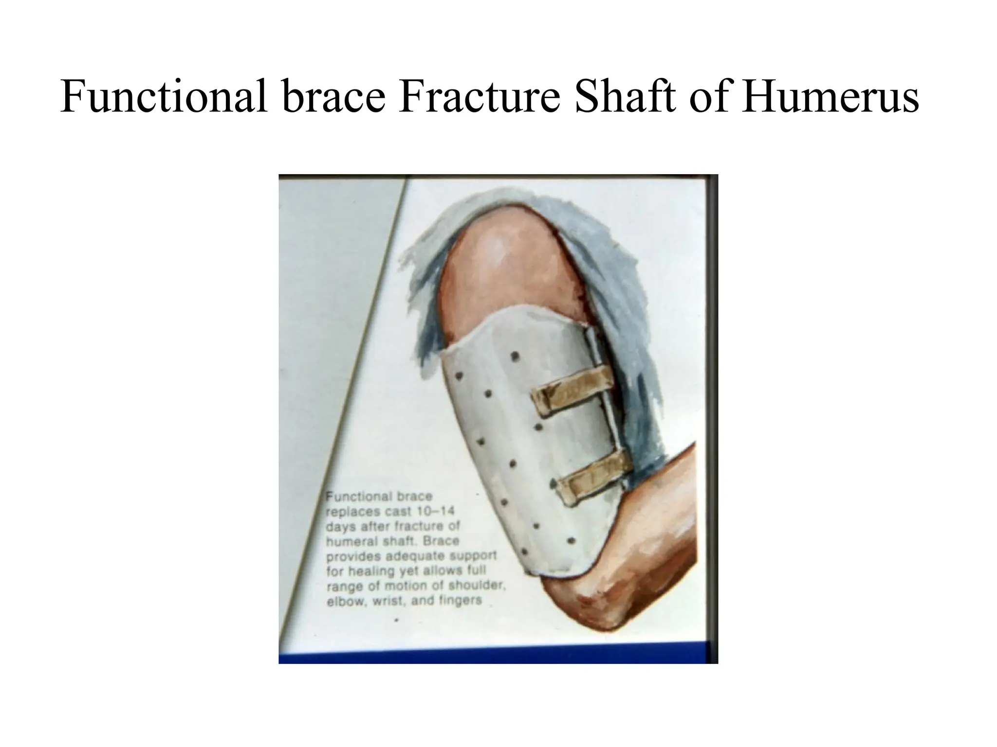 upper limb, injuries of the upper limb, detailed | PPTX