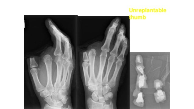 Upper limb amputation rehabilitation