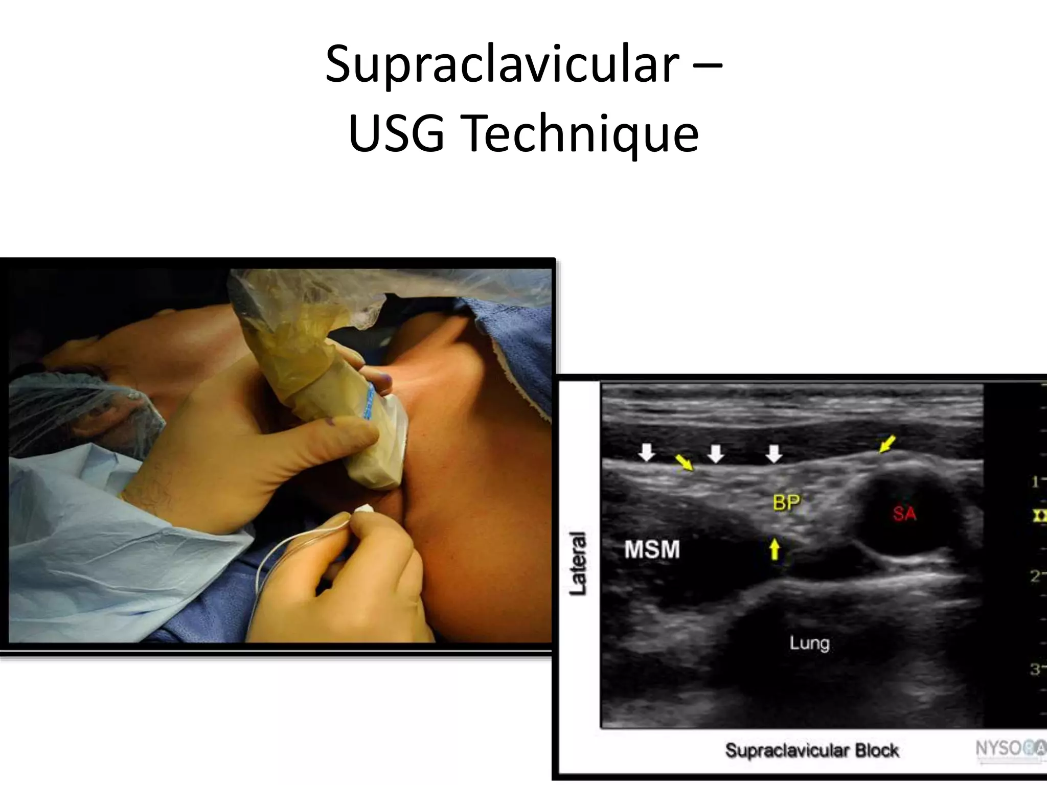 Upper limb blocks | PPT