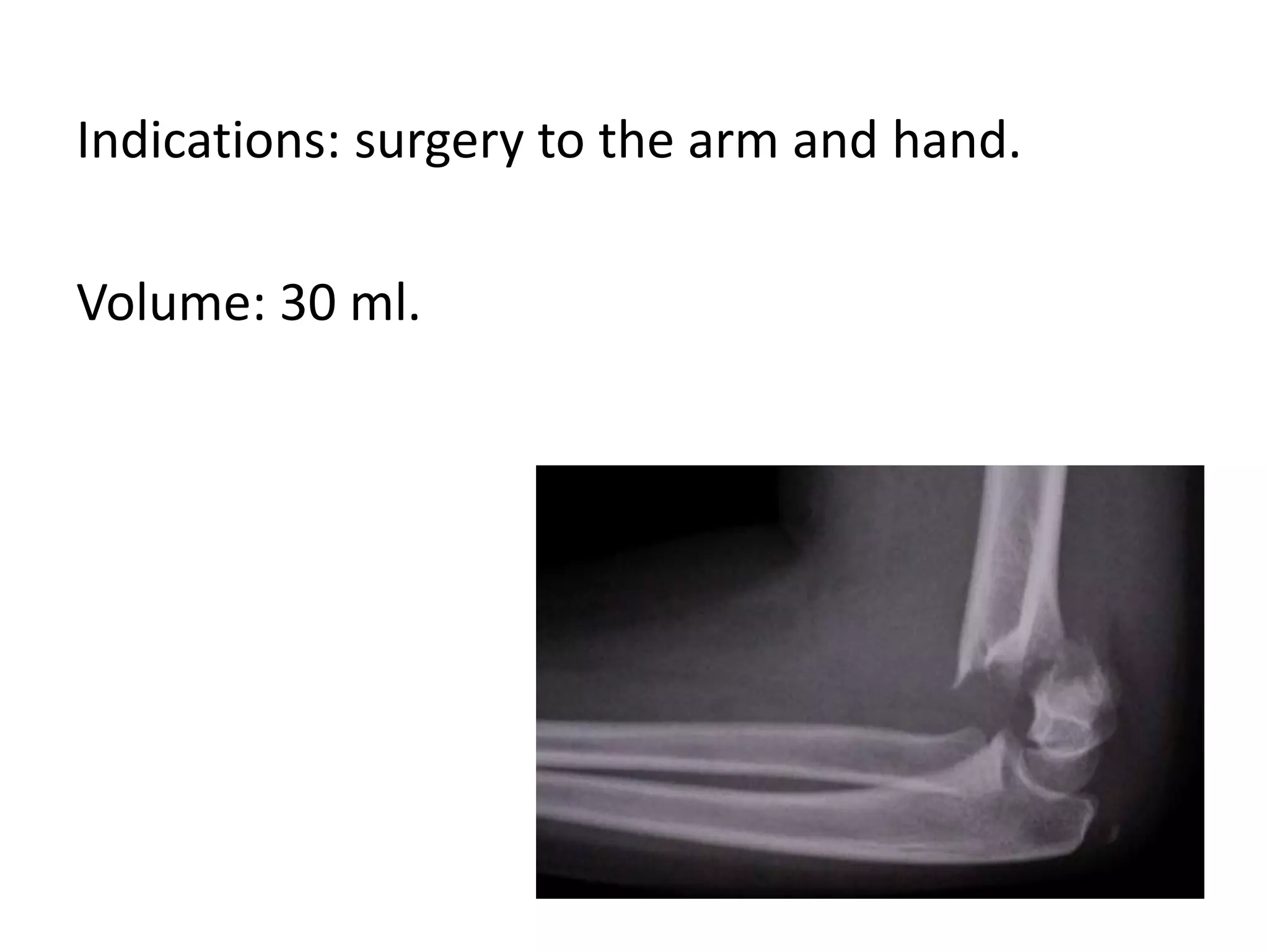 Upper limb blocks | PPT
