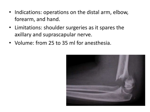 Upper limb blocks | PPT | First Aid | Injuries