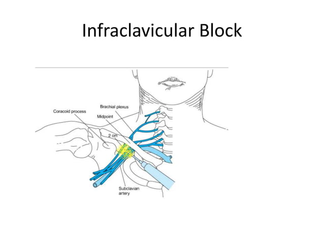 Upper limb blocks | PPT | First Aid | Injuries